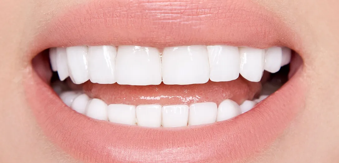 Tooth Bonding | Jade Dental