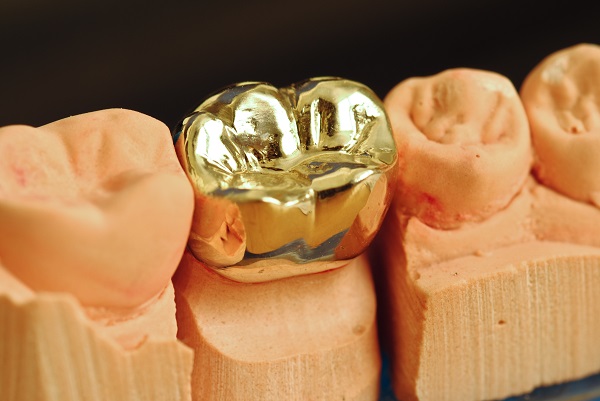 When a Dentist May Recommend a Gold Dental Crown - Sarko Dental ...