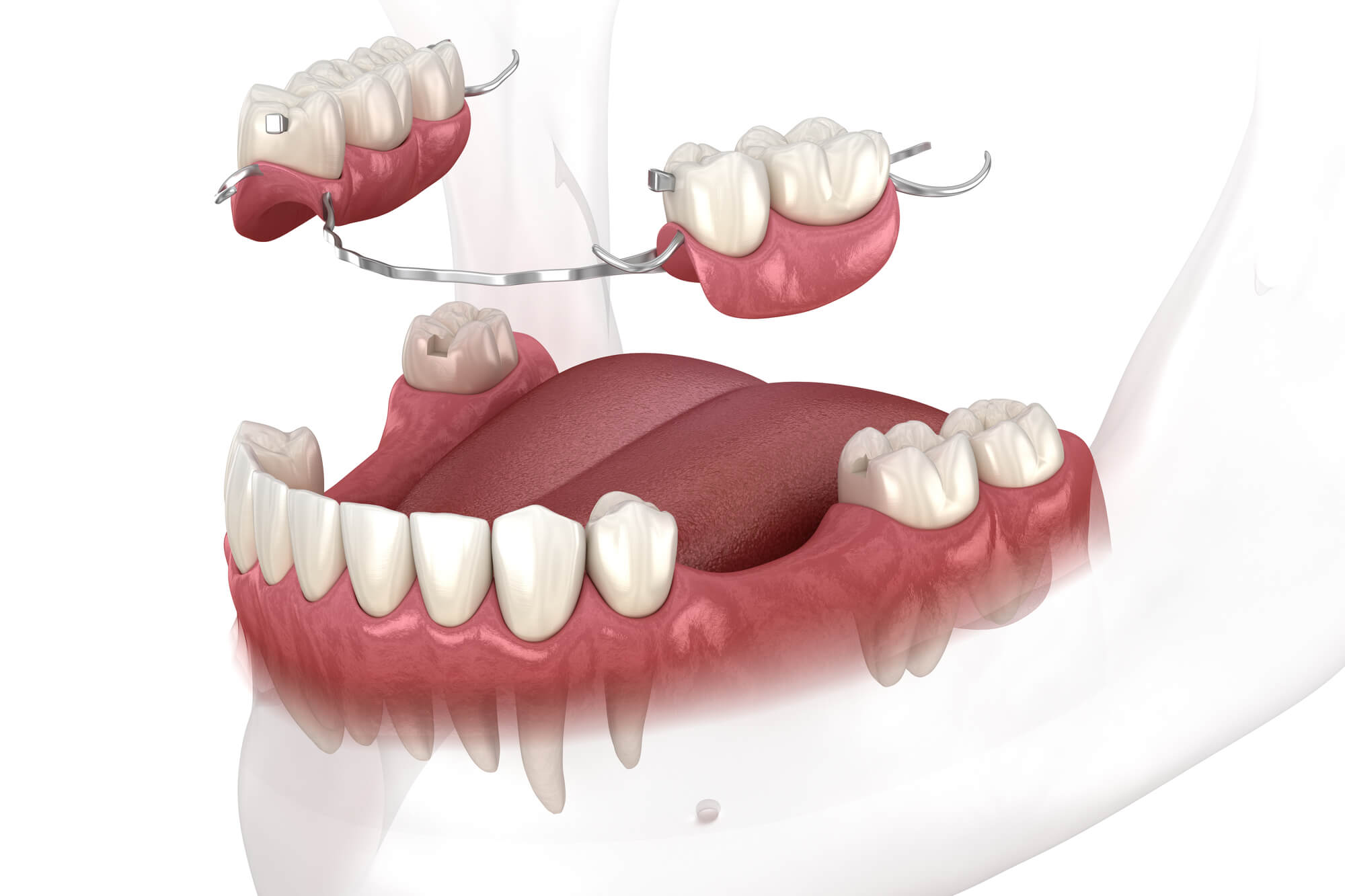 Flippers and Removable Partial Dentures | Zsambeky, Chaney, & Associates