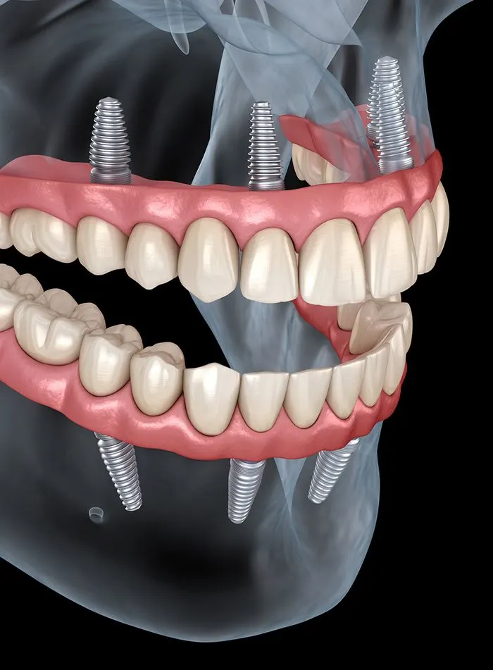 Full-Arch Implant Restorations in Los Angeles | Parikh Prosthodontics