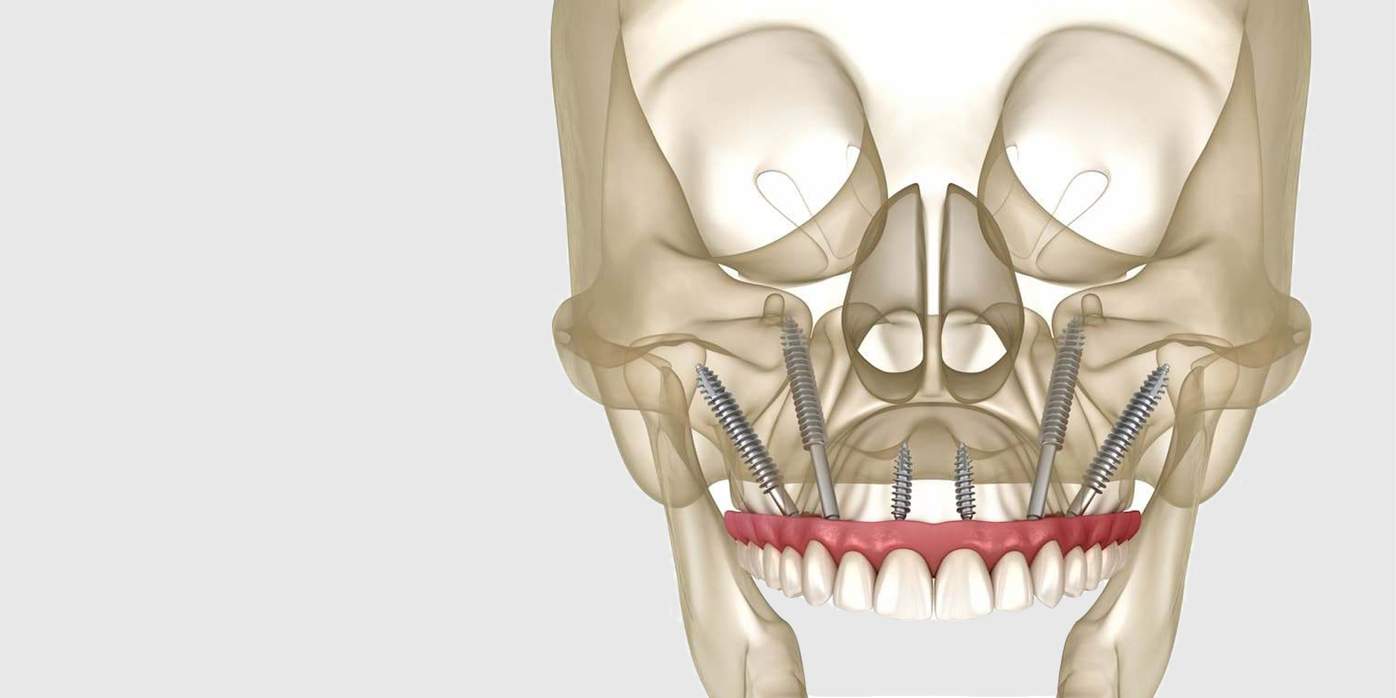 Zygomatic Implants | Houston, TX | Friedberg & Assoicates