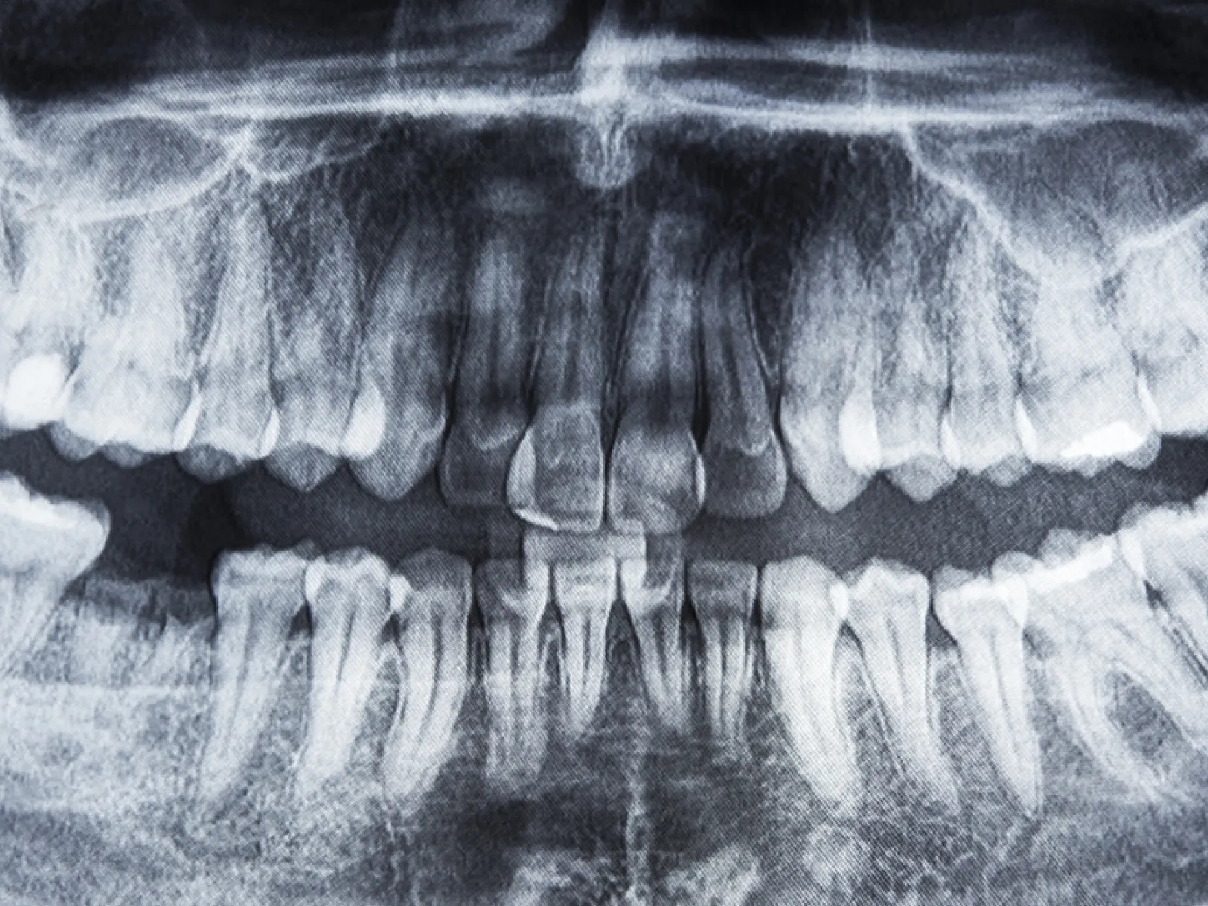 Wisdom Teeth Removal & Extractions | Mt Airy, MD