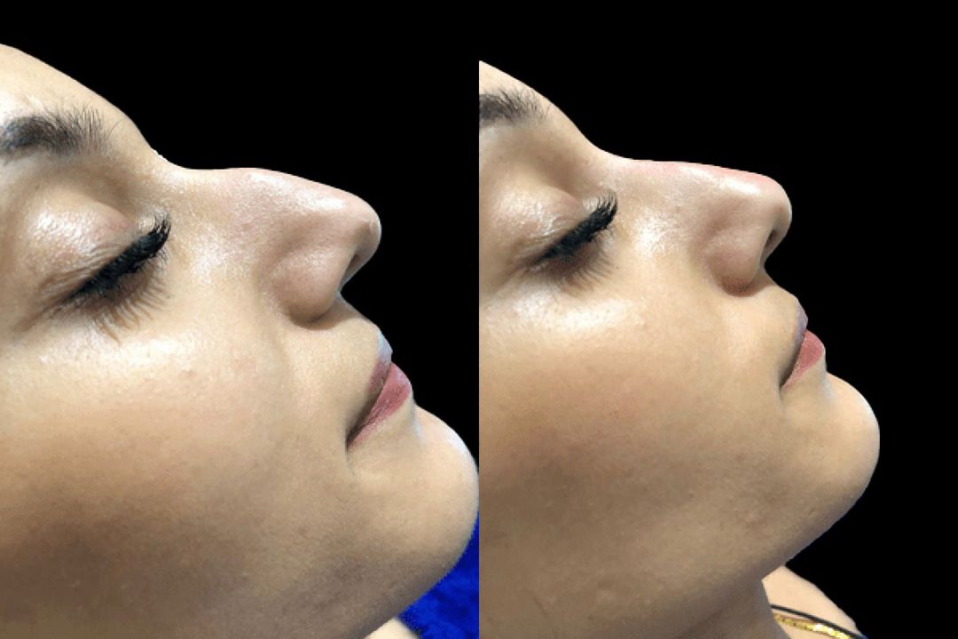 Non Surgical Nose Job | Non Surgical Rhinoplasty – Dr Ash Labib
