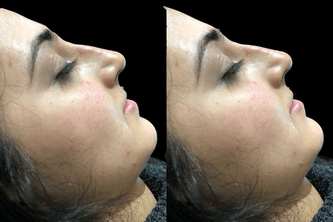 Non Surgical Nose Job | Non Surgical Rhinoplasty – Dr Ash Labib