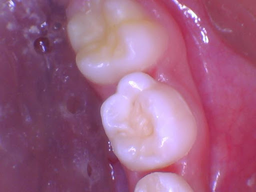 Baby Root Canal at Castle Hills Pediatric Dentistry